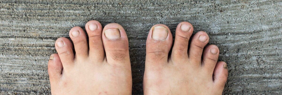 Treating Ingrown Toenails at Home | Foot & Ankle Specialists of Central PA