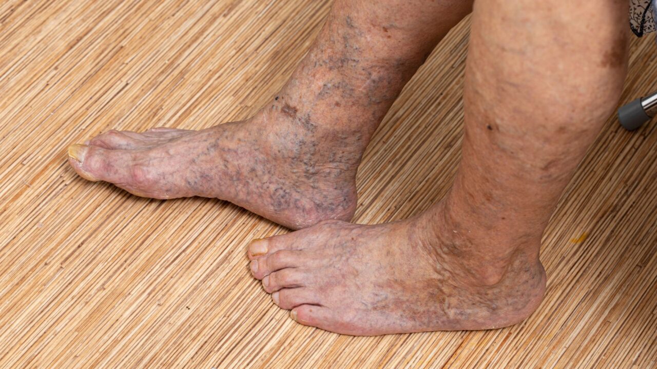 PAD and Diabetic Foot Care | Foot & Ankle Specialists of Central PA